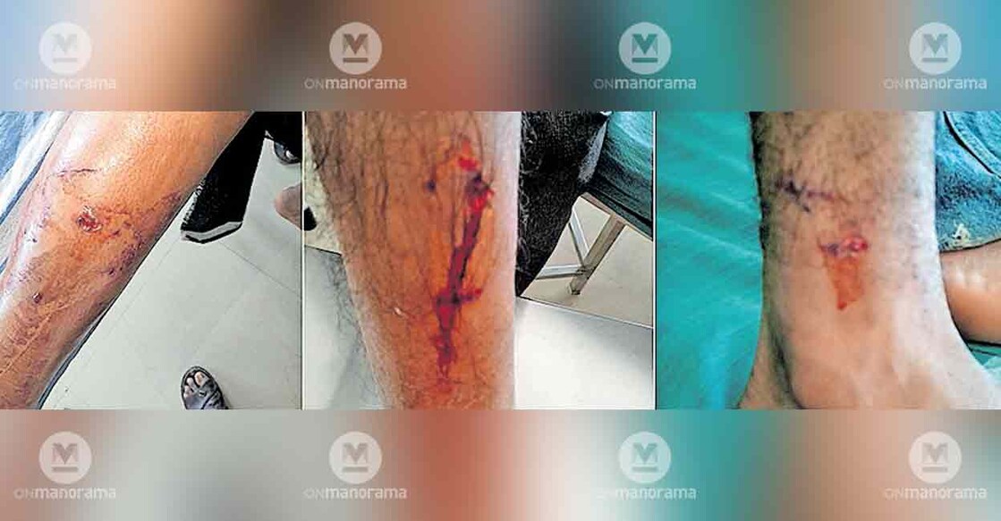 Even election candidates not spared: Stray dog attack injures 11 in ...