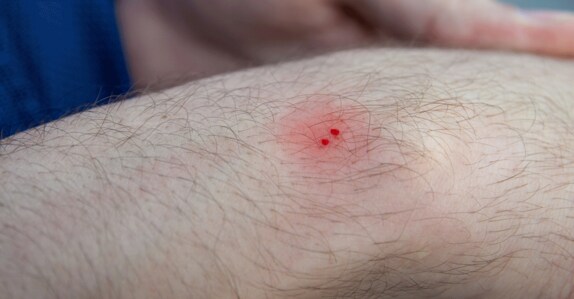 pit viper bite wound