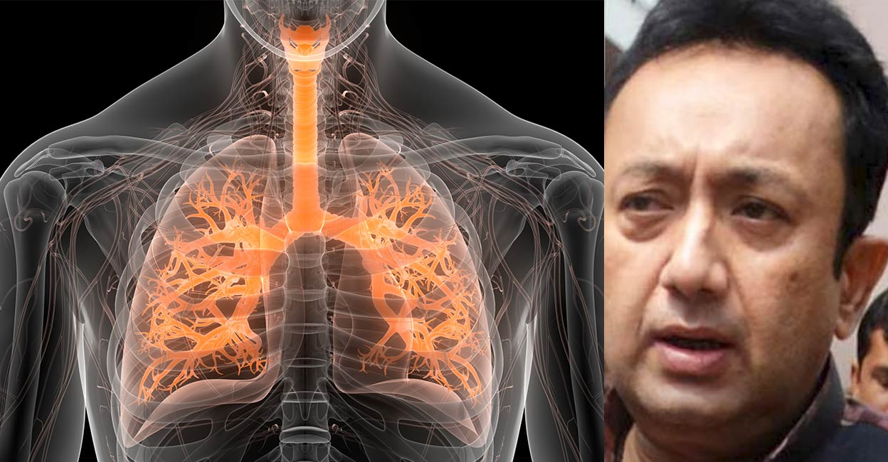 The infection that worsened actor Joy Banerjee's health | Health | Onmanorama