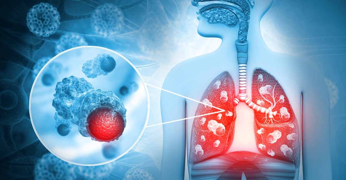 Early signs of tuberculosis; detection and treatment: Doctor explains | Health | Onmanorama