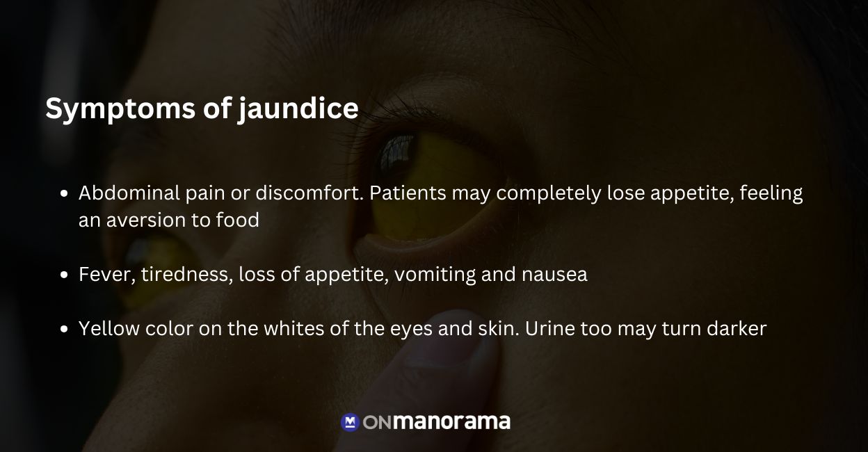 Jaundice spreads without prominent symptoms: Doctor explains | Health | Onmanorama