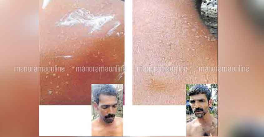 Two suffer sunstroke in Wayanad | sunstroke | Wayanad | heat | Kerala