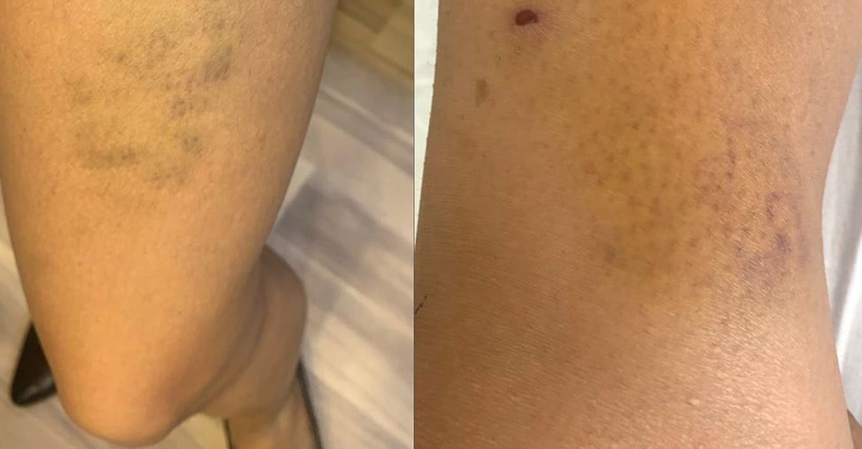 Anna Ben shares pics of injury marks on 'Kalki 2898 AD' film set ...