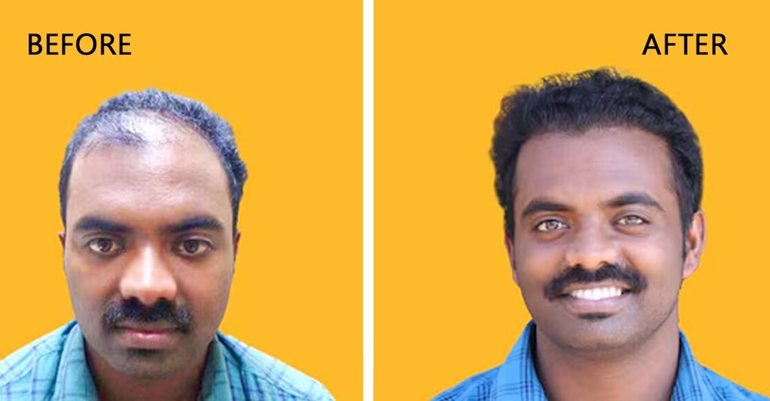 Hair loss is no more irreparable: Here are some of best transplant ...
