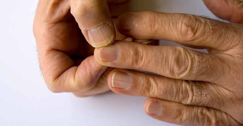 Learn about your health from nails | Nails | anaemic | heart | liver ...