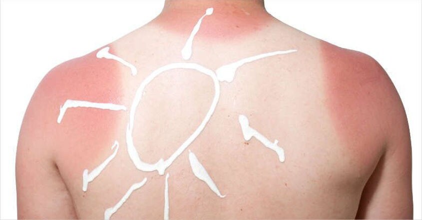 After Rain N Flood Scare Save Yourselves From Sunburns Sunburns