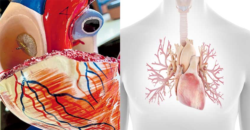 Fixing hole in the heart sans surgery: Sree Chitra develops unique ...