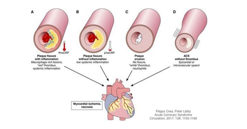 How common is heart attack in young adults? Is there a need to worry?