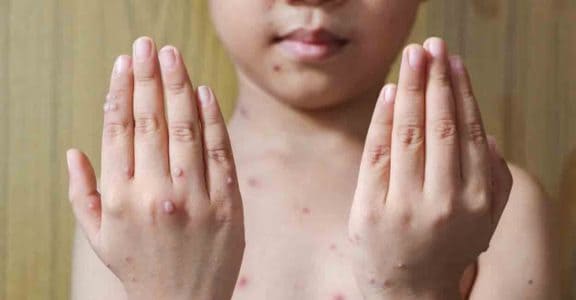 Summer diseases: How to stay away from chickenpox? | Health | Onmanorama