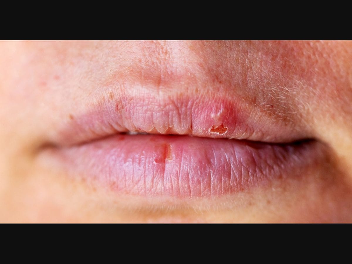Lip Cancer Early Stages